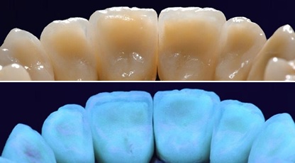 Enamel Porcelain | Dental CAD/CAM | DENTALXS